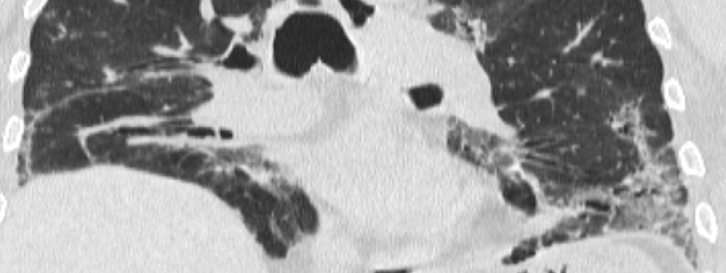 RAIQC: Packages: Package Interstitial Lung Disease on HRCT